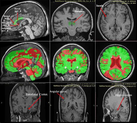 representative images showing the segmentation of magnetic resonance