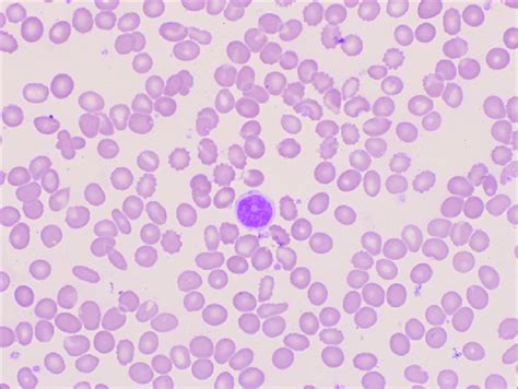 Circulating Prolymphocyte With Thrombocytopenia Download Scientific