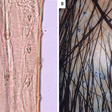 Pdf Tinea Capitis Caused By Trichophyton Tonsurans Presenting As An