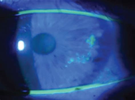 My Patient Has Herpetic Keratitis Now What