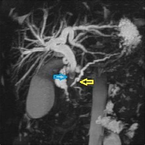 Magnetic Resonance Cholangiopancreatography Mrcp Shows Hepatobiliary Download Scientific