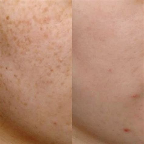 피코토닝 Vs 레이저토닝 비교 효과 부작용 가격 시술 간격 통증 문신 제거 총정리 네이버 블로그