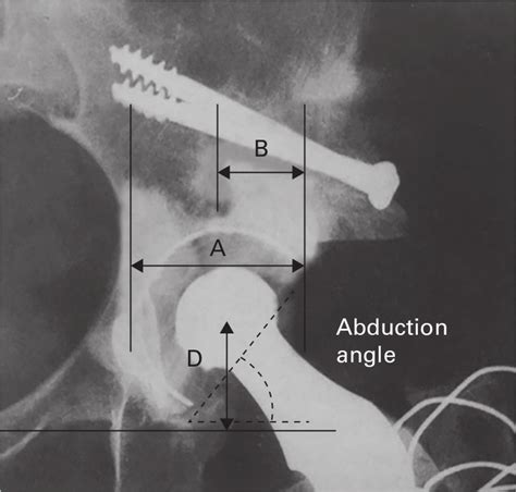 Cemented Acetabular Component With Femoral Neck Autograft For Acetabular Reconstruction In Crowe
