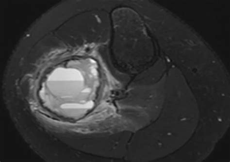Aneurysmal Bone Cyst Imaging Case 1