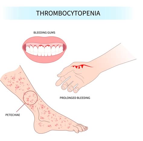 Immune Thrombocytopenia Itp Rcemlearning India