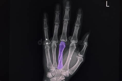 Fractured Third Metacarpal Bone Stock Image Image Of Joint Medicine 225916191