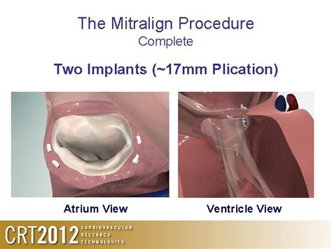 Mitralign Direct Annuloplasty For Fmr An Update On