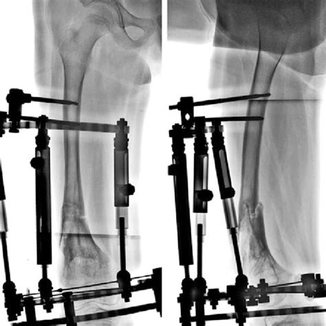 Ring External Fixator Radiograph Shows A Ring External Fixator Download Scientific Diagram