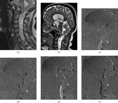Cerebrospinal Fluid Flow Imaging By Using Phase Contrast Mr Technique Pmc