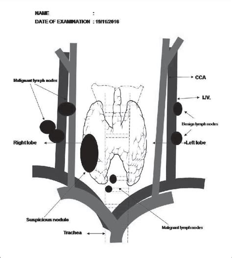 Schematic Representation Of Lymphatic Mapping Of The Neck In A Patient Download Scientific