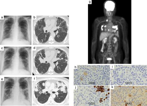 A B Chest Radiography And Ct Images Obtained In 2017 Reticular And