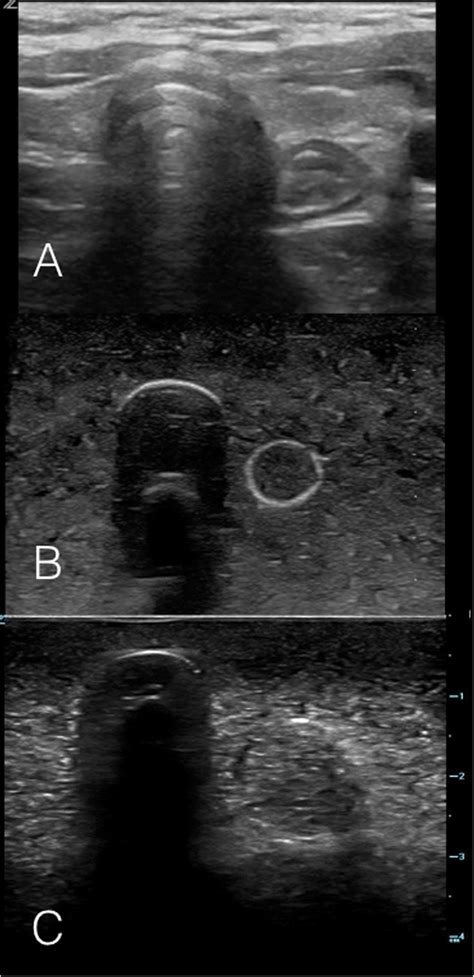 Ultrasound Images On The Simulator Model Tracheal Intubation A Static