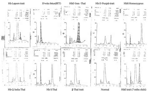 Ce Hplc Chromatograms Of Some Hemoglobin Variants Seen In