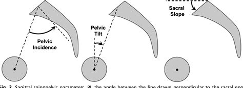 Figure 3 From Classifications For Adult Spinal Deformity And Use Of The