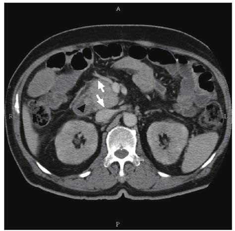 Contrast Enhanced Abdominal Computed Tomography Displaying A 1 Cm