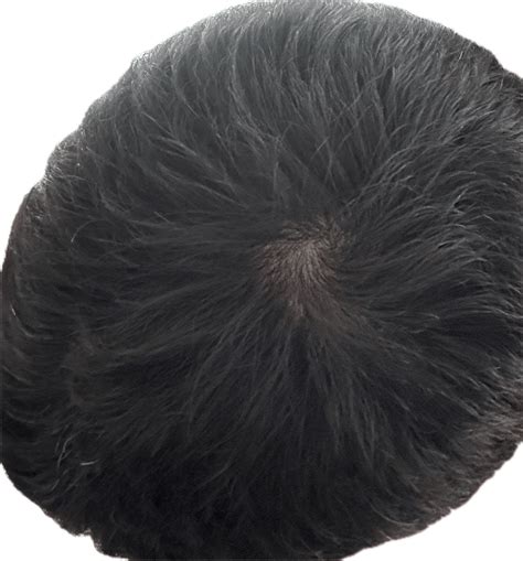 Balding Or Normal Hair Crown Rmalehairadvice