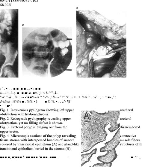 Figure 1 From Hydronephrosis Due To Fibroepithelial Ureteral Polyp In A