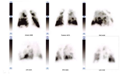 Multiple Segmental Perfusion Deficits Moderate Severe In Lung