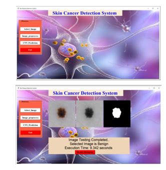 Skin Cancer Detection Using Image Processing
