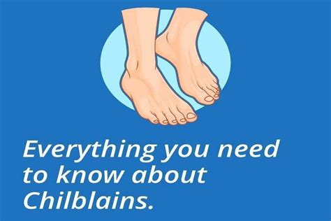 Chilblains