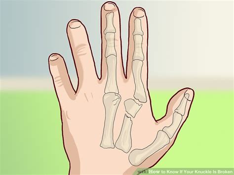 Doctor Approved Advice On How To Know If Your Knuckle Is Broken