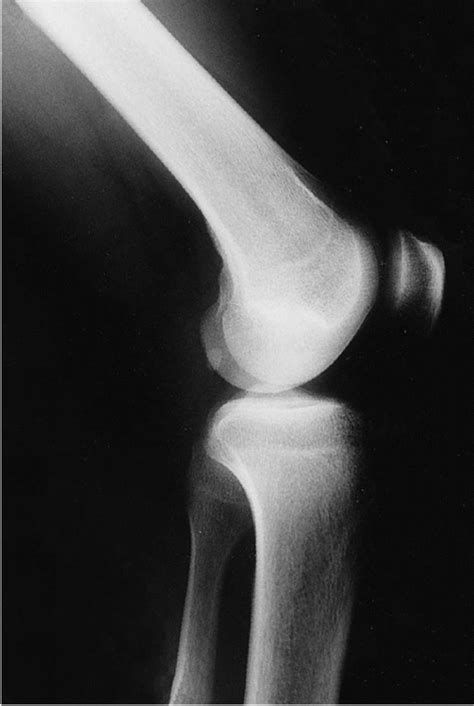Lateral Knee Diagram Quizlet