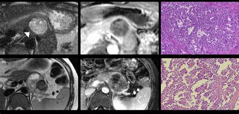A Patient In Her 10 S With Solid Pseudopapillary Neoplasm Purely Solid