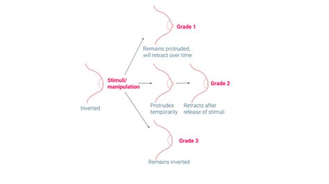 Nipple Correction Inverted Nipple Surgery Cost And Guide