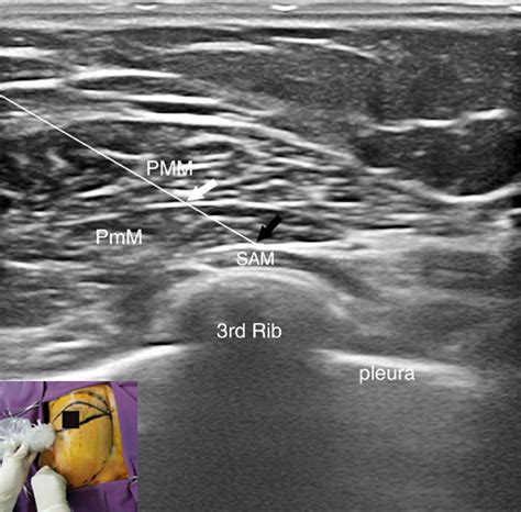 Type Ii Pectoral Nerve Block Guided By Ultrasound Notes Black Arrow Download Scientific