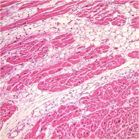 Arrhythmogenic Right Ventricular Cardiomyopathy Arvc D A Systematic Literature Review Pmc
