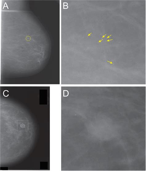 Whole Breast Mammograms A C And The Corresponding Partial View Download Scientific Diagram