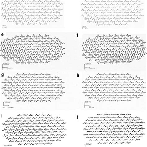Serial Humphrey Visual Field 24 2 Total And Pattern Deviation Plot At Download Scientific