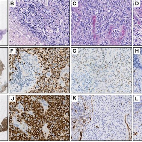 Ngs Testing Of The Tumor To Validate Ntrk1 Fusion A Dna Based Ngs