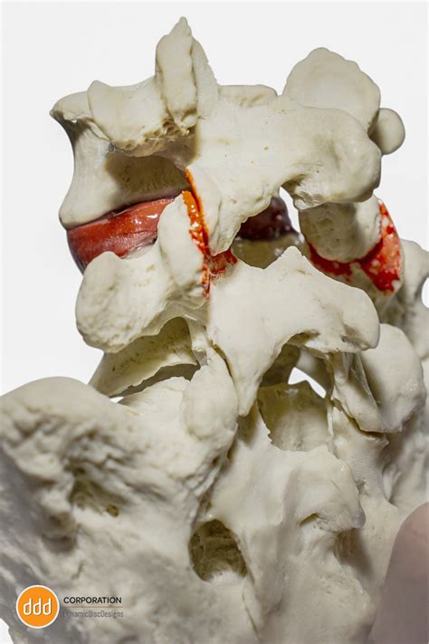 Bertolotti Syndrome Model Dynamic Lstv Vertebrae 3dmodel