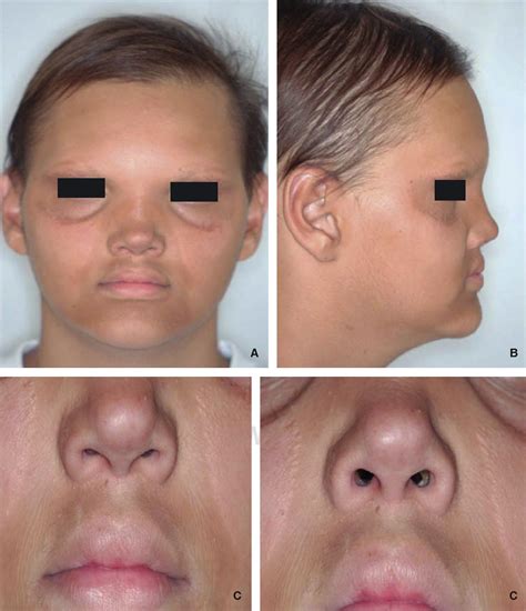 Hypohidrotic Ectodermal Dysplasia Clinical And Radiographic
