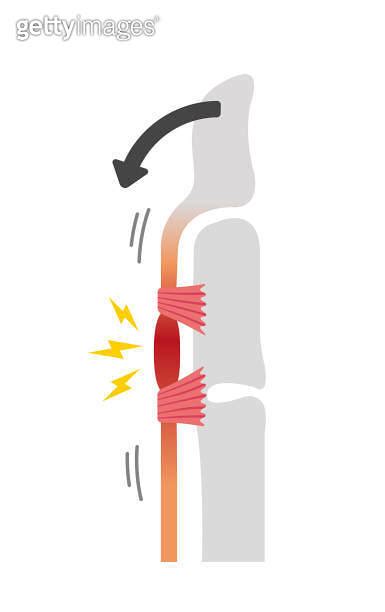 Trigger Finger Causes And Symptoms Illustration When Bending 이미지 1189267346 게티이미지뱅크