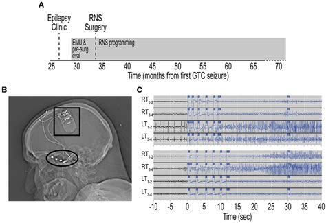 Treatment Timeline With Rns Placement And Temporal Lobe Seizure