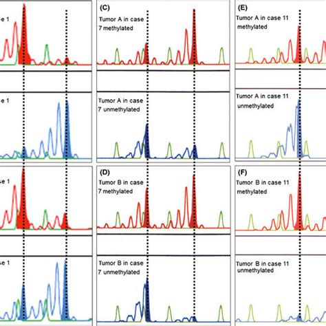 A F Representative Results Of X Chromosome Inactivation Patterns By