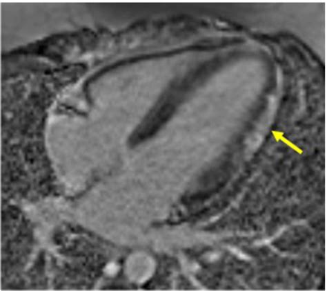 four chamber delayed enhancement phase sensitive inversion recovery