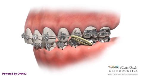 Orthodontist Class 2 At Jackie Mckinney Blog