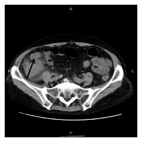 Abdominal Ct The Appendix Shows A Mass Measuring 5 × 4 × 4 Cm The