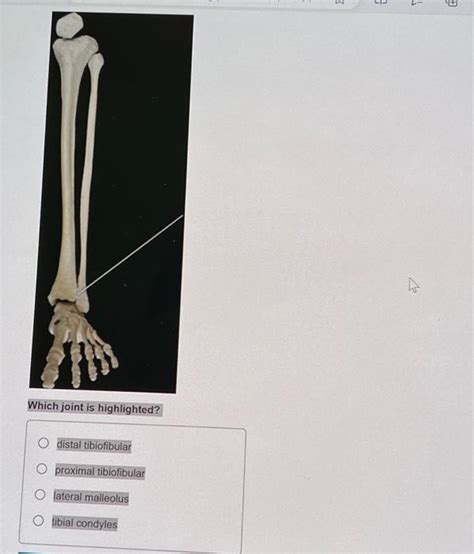 Solved Distal Tibiofibular Proximal Tibiofibular Lateral