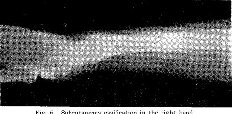 Figure 6 From A Case Of Pseudo Pseudohypoparathyroidism Semantic Scholar