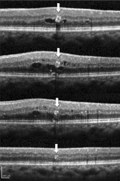 Characterization Of Microaneurysm Closure After Focal Laser
