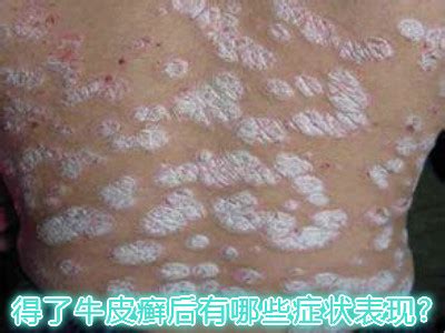 牛皮癣的症状图片表现儿童大山谷图库