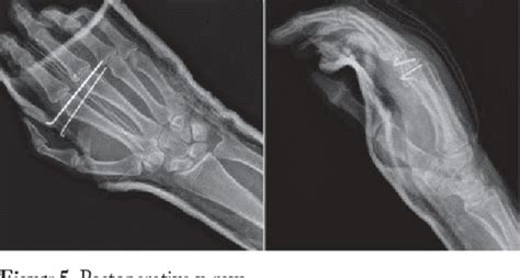 Figure 4 From Complex Lesion Of The Third Metacarpophalangeal Joint Complete Tear Of The Radial