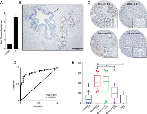 Pcat14 Rna Ish In Prostate Cancer Tissues A Barplot To Show The Download Scientific Diagram