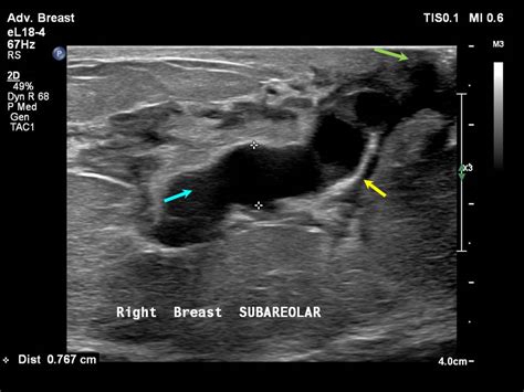 Atlas Of Breast Cancer Early Detection