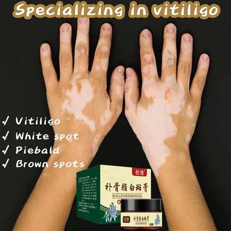 Vitiligo Cream Vitiligo Remover 20g White Spot Treatment Cream Ointment