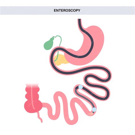 Premium Vector Balloon Assisted Enteroscopy Visualization Of The Small Intestine Nonsurgical